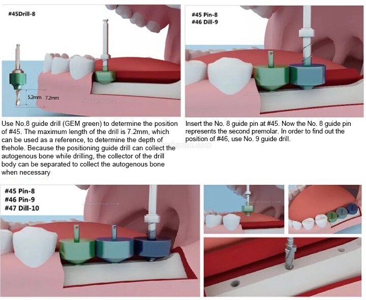 Buy Cheap Dental Implant Surgical Guide Drill Guide Pin Bone Trimmer ...